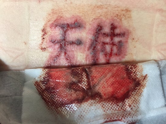 bleeding tattoo removal