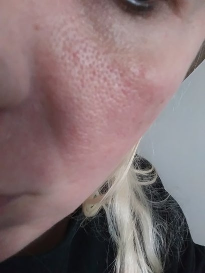 Atrophoderma Vermiculatum