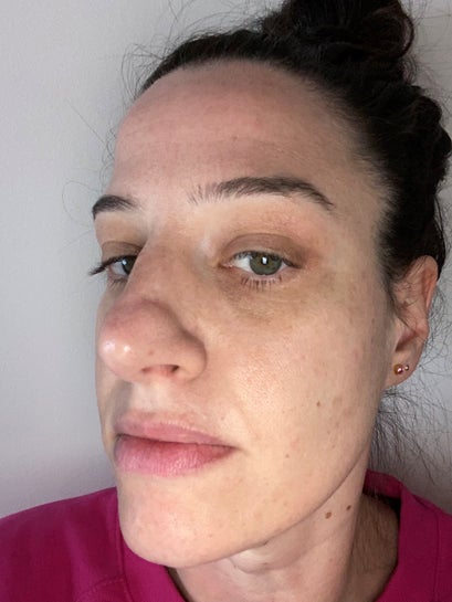 Cyst On Side Of Nose Clinical Photograph Of Patient Showing Dermoid