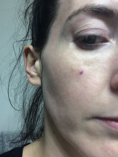 Rosacea Laser Treatment Bruising