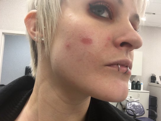 burn mark on face