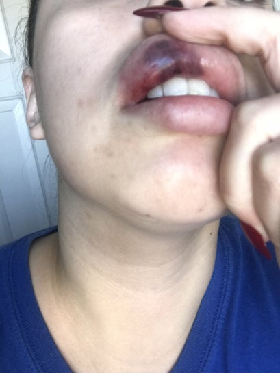 Popped Blood Vessel After Lip Filler - Infoupdate.org