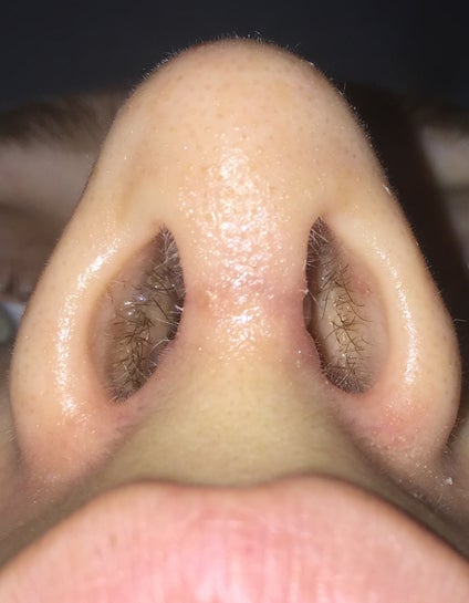 Swollen Inside Nose