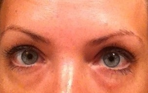 Swollen Eyebrow Bone