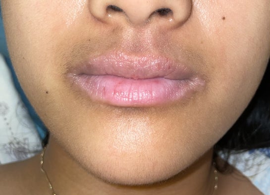 angular cheilitis scars