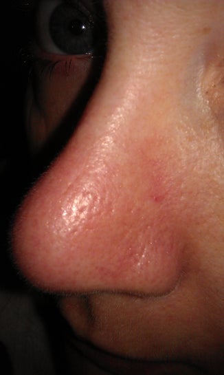 Orange Peel Texture Skin On Nose