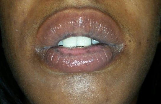 Loss Of Color In Lips - Infoupdate.org