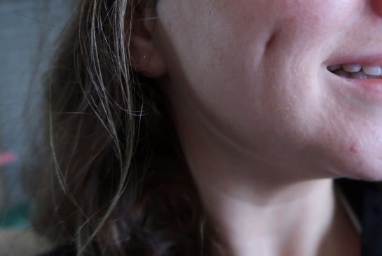 Dimples Piercing Scars