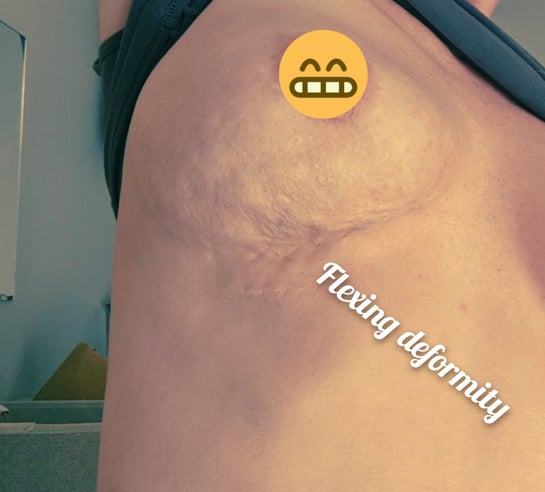 deformed breast implants