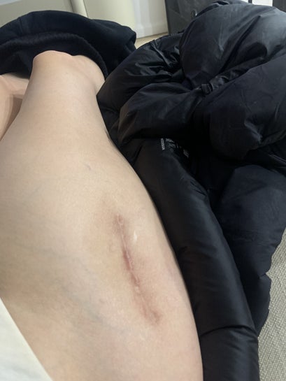 hip replacement scar