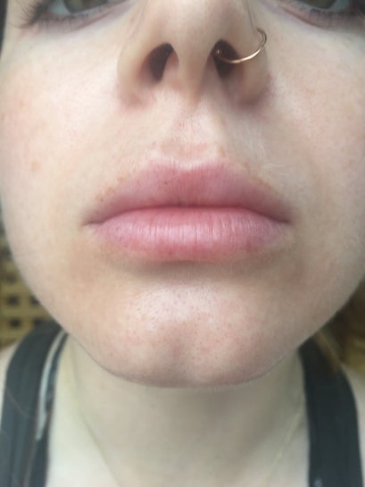 Vertical Labret Piercing Scar - Infoupdate.org