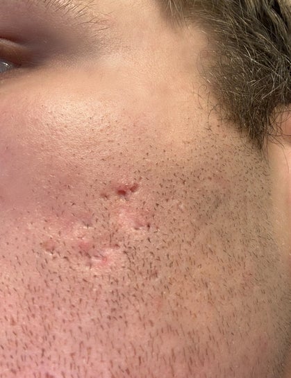 Acne Cyst With Surrounding Scarring