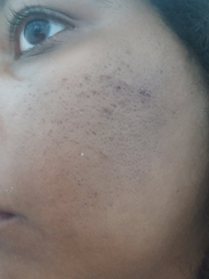 What Does A Black Spot On Your Cheek Mean - Infoupdate.org