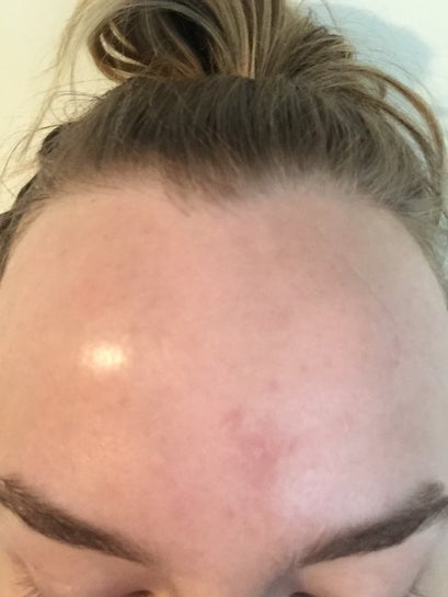 birthmark on forehead between eyebrows