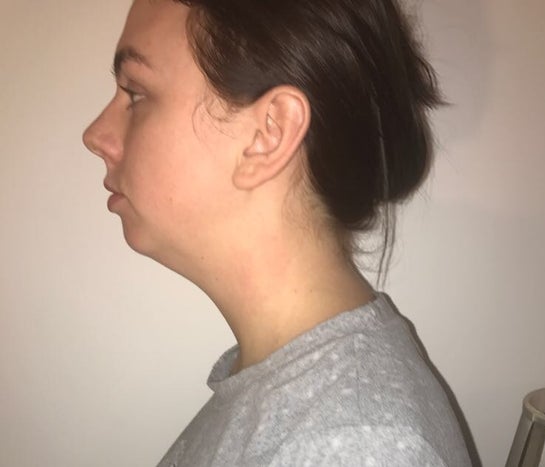 No Jawline Definition