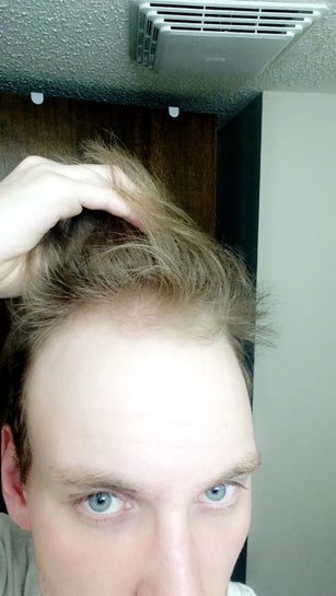 Big Forehead Unattractive