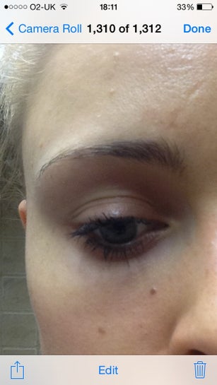 Tyndall Effect Juvederm