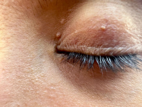 Bumps on eyelid and corner of eye. How can I get these removed Photo