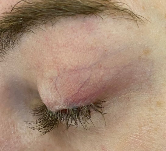 Eyelid Veins Pre Operator Aspect Of The 30 Year Old Women; The