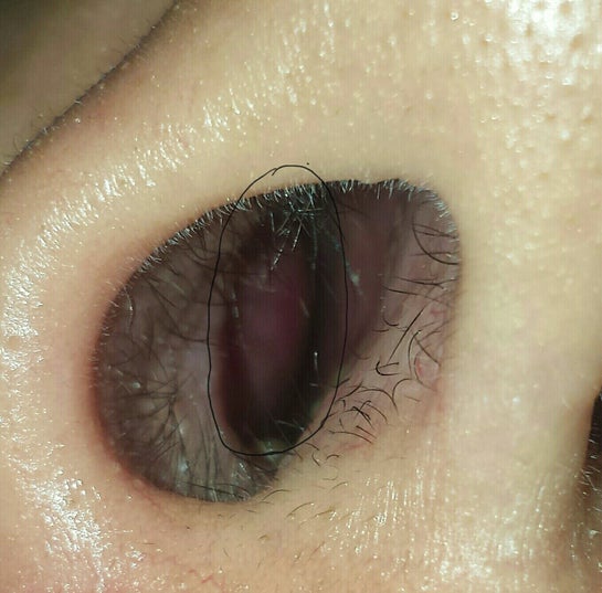 normal nasal turbinates