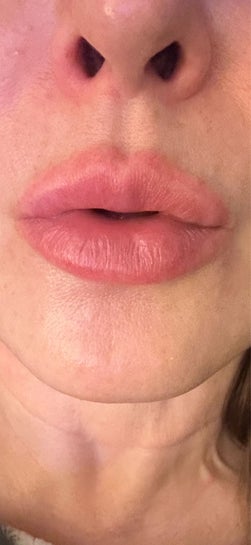 Red Rash On Top Of Upper Lip - Infoupdate.org