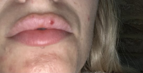 Can You Burst A Blood Vessel In Your Lip - Infoupdate.org