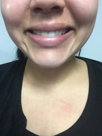 Why Do I Have Mouth Corner Dimples - Infoupdate.org