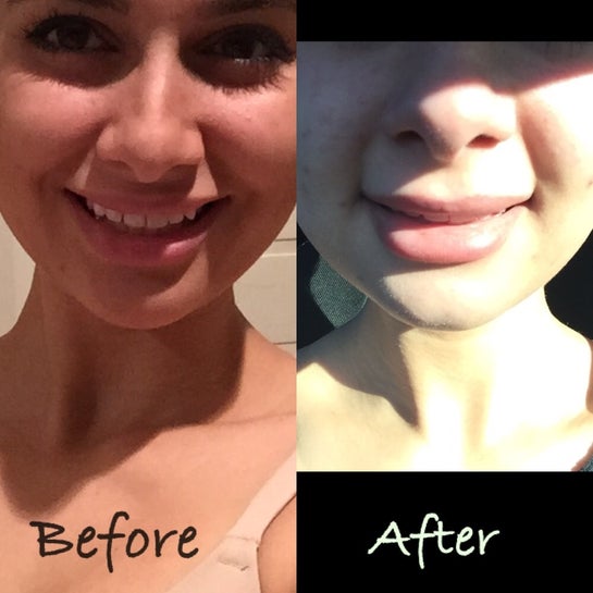 Botox Injections Gone Wrong