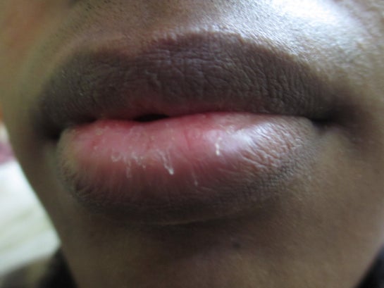 Why My Lower Lip Is Bigger Than The Other Side - Infoupdate.org