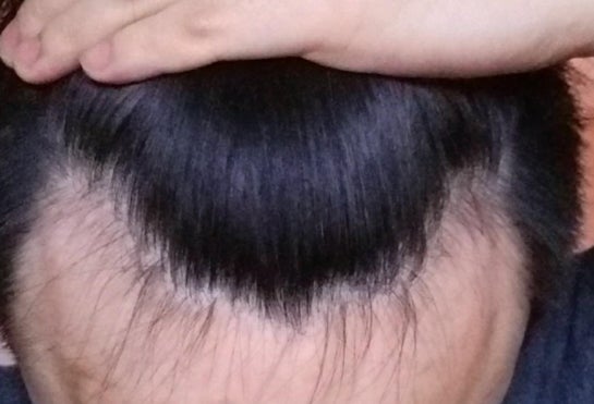 What norwood would still be considered as a good hairline? : r/tressless