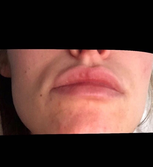 Small Bumps On Lips After Filler