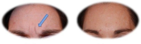 Botox Before & After Pictures - RealSelf