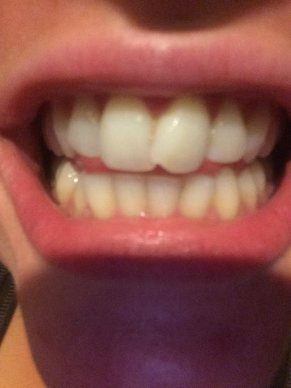 Crooked Front Teeth Fix