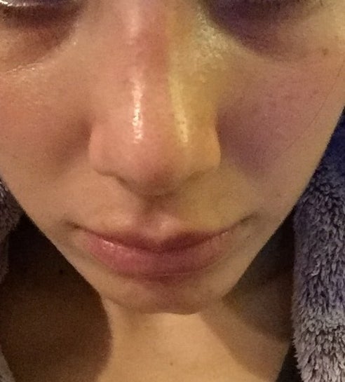 Redness on bridge of nose. Is this normal photos