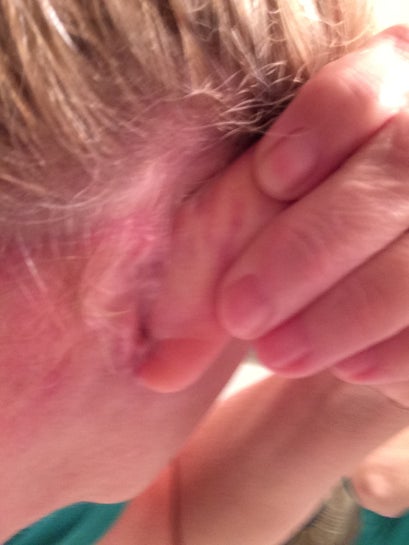 Keloid Scar Behind Ear