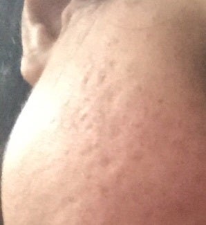 shallow rolling scars