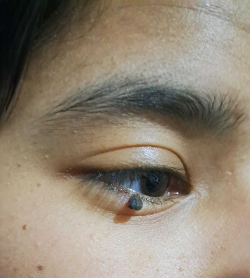 mole under eye
