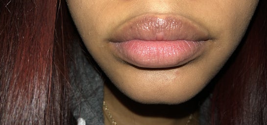 Why My Lower Lip Is Bigger Than The Other Side - Infoupdate.org