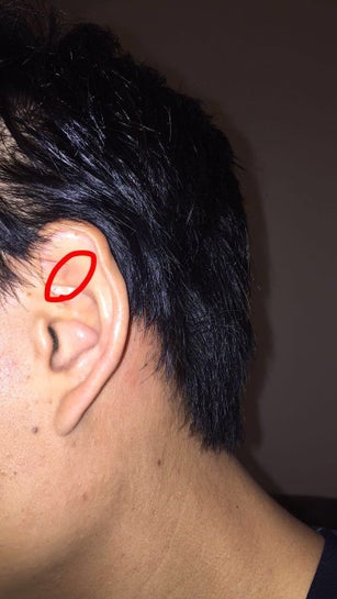 Broken Cartilage Ear You Will Be Shocked At The Dangers Of Ear