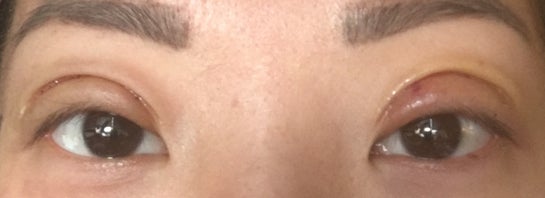 Triple Eyelid