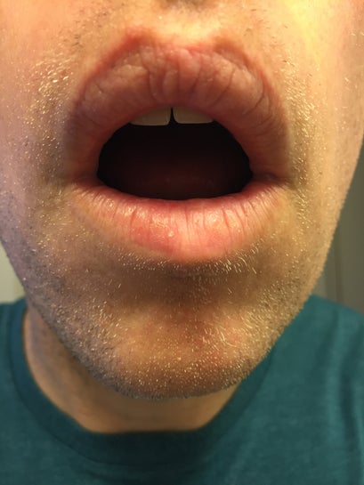 Redness Around Vermilion Border