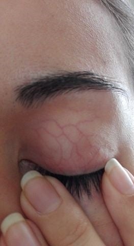 Popped Blood Vessel In Eyelid - Infoupdate Wallpaper Images