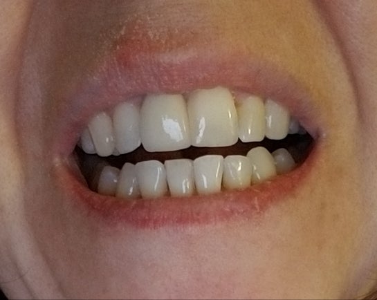 Can Canine Teeth Be Filed Down