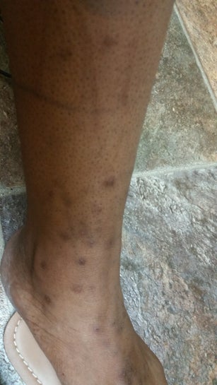 Flea Bites On Dark Skin