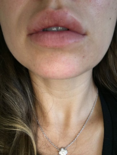 Why Is My Upper Lip Losing Color - Infoupdate.org