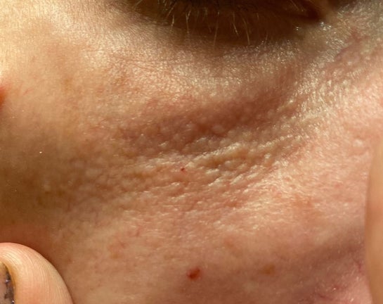 bumpy texture under eyes