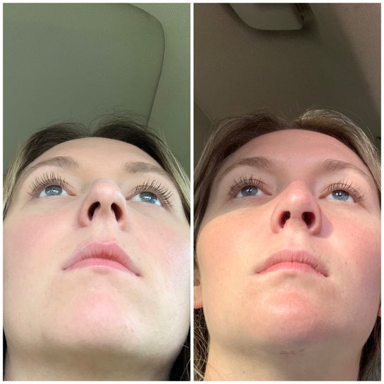 asymmetrical nostrils