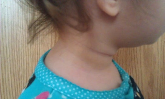 are neck rolls normal