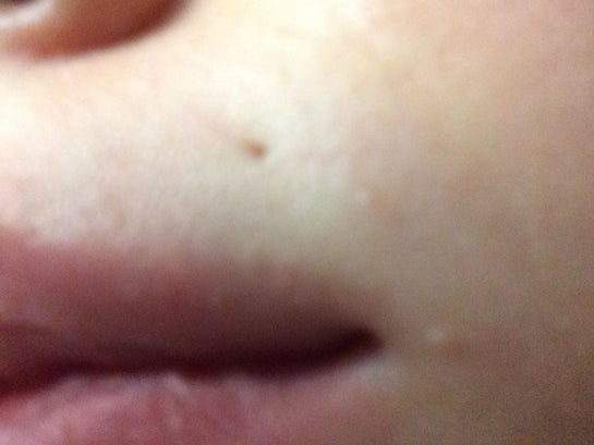 dermal piercing scar