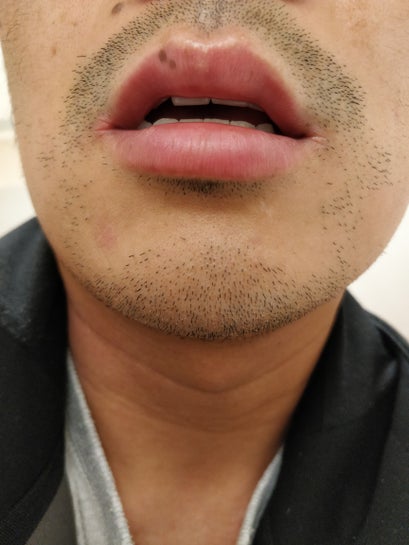 angular cheilitis scars